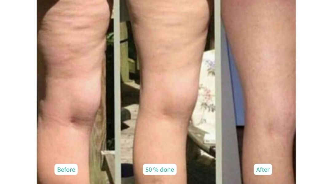 Cellulite Treatment - Case 8 - Beautify Spa